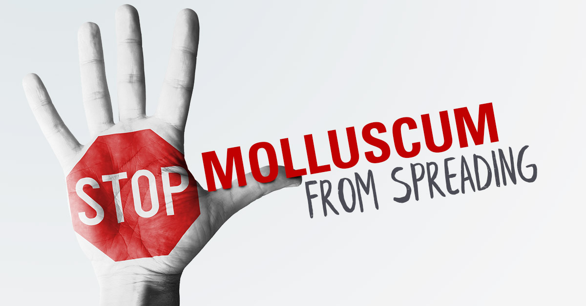 How to Stop Molluscum Contagiosum from Spreading to Other Parts of Your ...